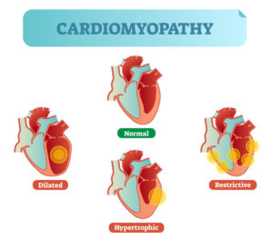What is Cardiomyopathy, Symptoms, And Treatment? - Pulse Cardiology